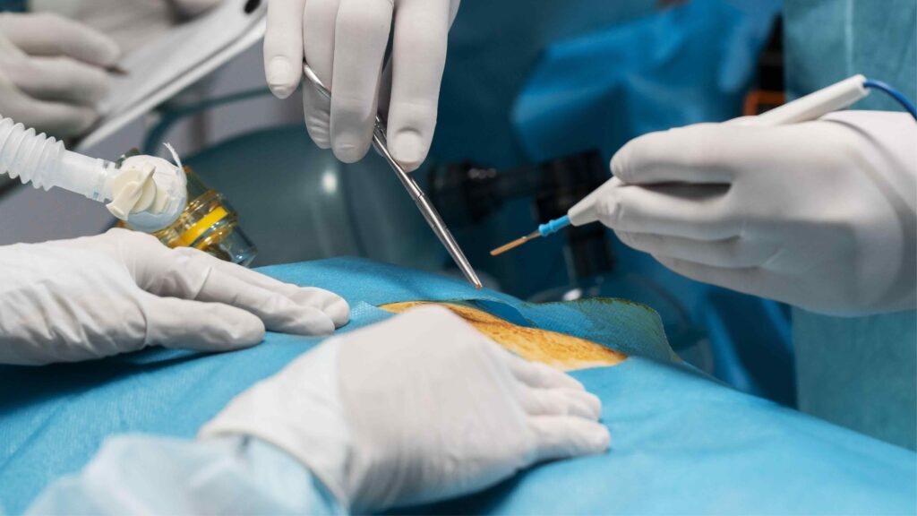 Phaco Surgery Under 3D Microscope - Prof Brig Gen Dr Ismail Hossain